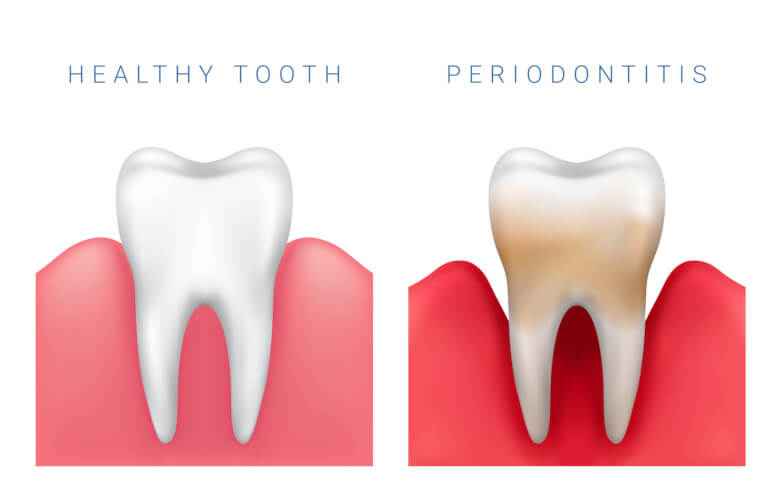 Periodontitis | Expert Prevention and Treatment of Gum Disease