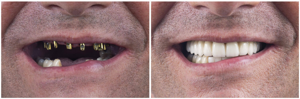 Multiple Teeth Implants | Your Trustworthy Oral Surgery Specialist in ...
